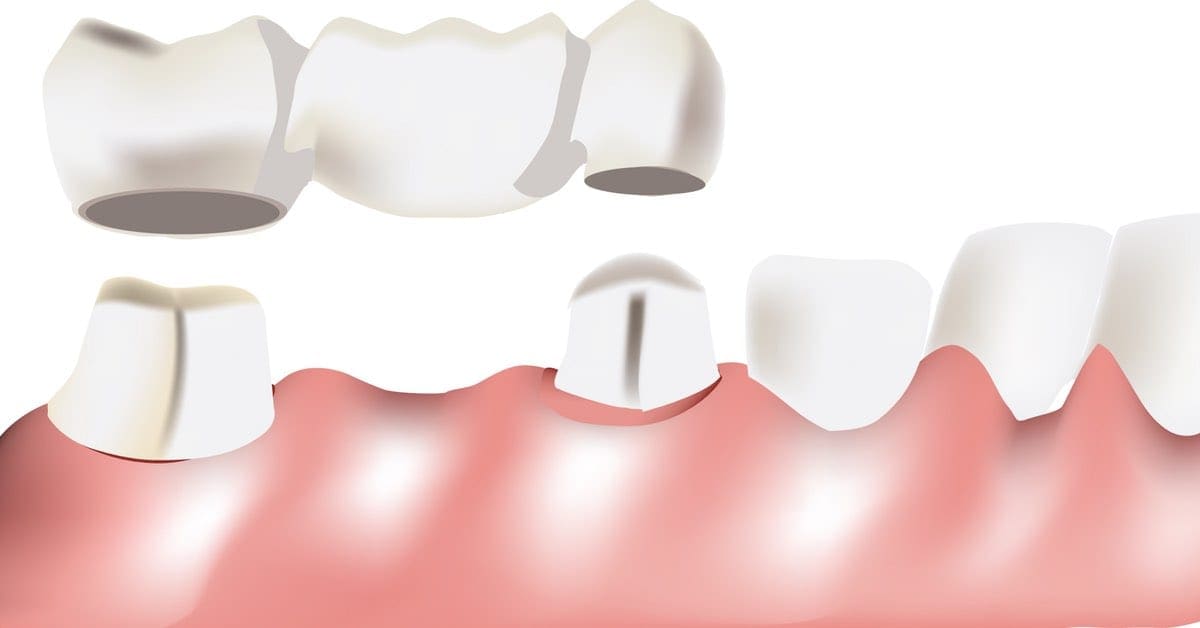 Dental Bridges To Replace Missing Teeth