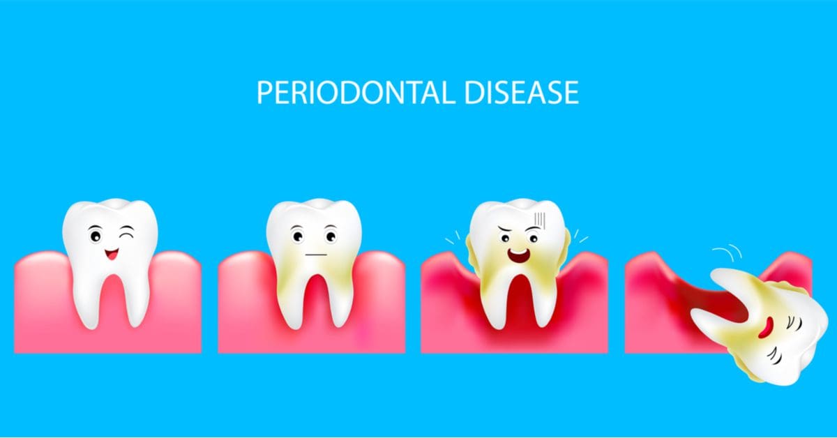 What Causes Gum Disease? | Suburban Essex Dental