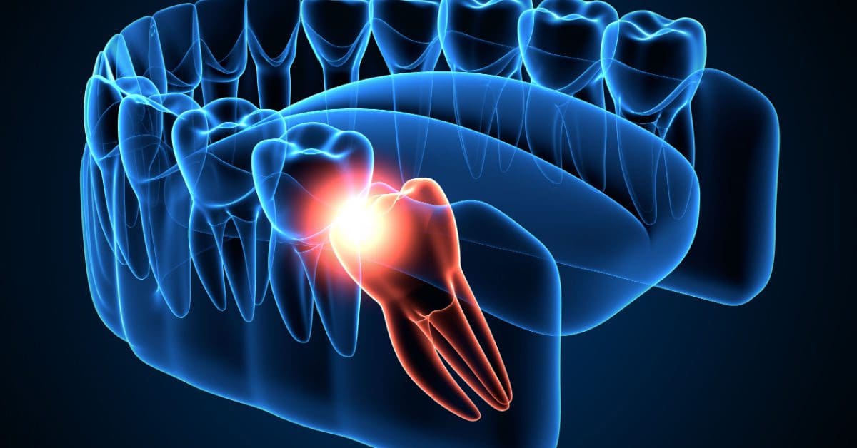 Wisdom Tooth Extraction Near Me | Suburban Essex Dental